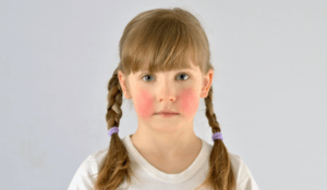 What Causes Red Cheeks in a Child? | Vujevich Dermatology