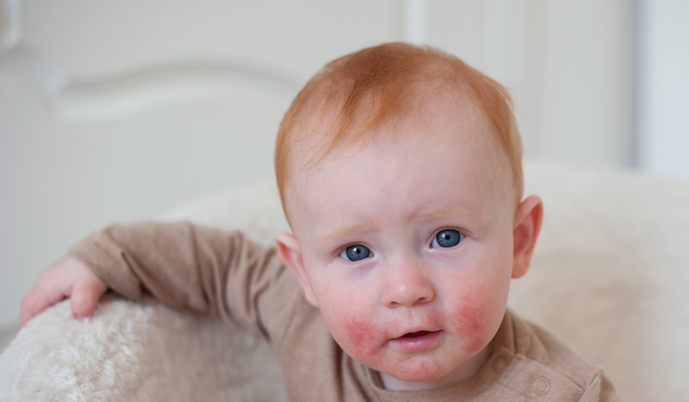 Atopic Dermatitis in Children | Vujevich Dermatology