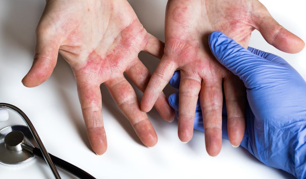 Atopic Dermatitis vs Eczema | Vujevich Dermatology