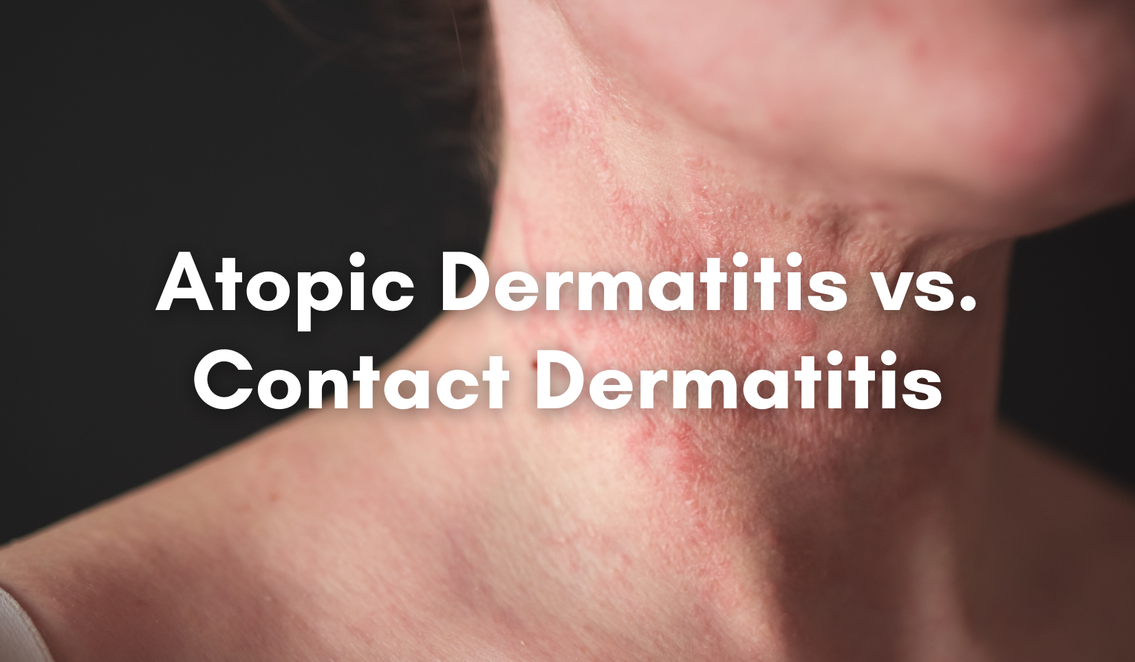 Atopic Dermatitis vs Contact Dermatitis | Vujevich Dermatology